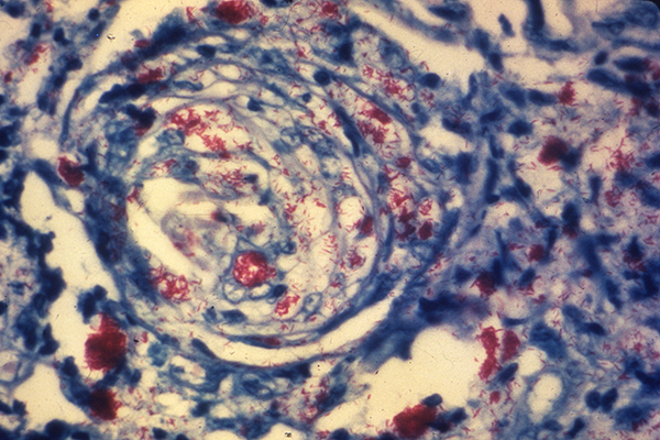 Leprosy: An Ancient Disease That Continues to Linger - Pacific Standard